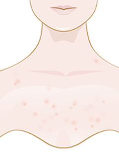 How to get rid of spots on your chest [Complete Guide]