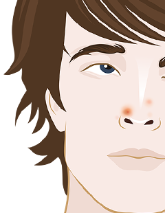 How to get rid of spots on the nose | The ultimate guide